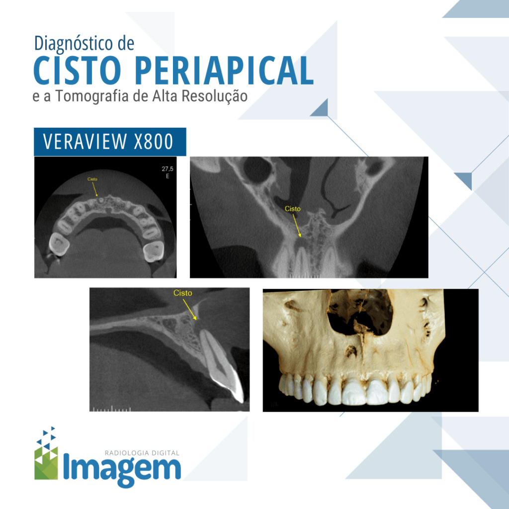 Diagnóstico de cisto periapical e a Tomografia de Alta Resolução ...
