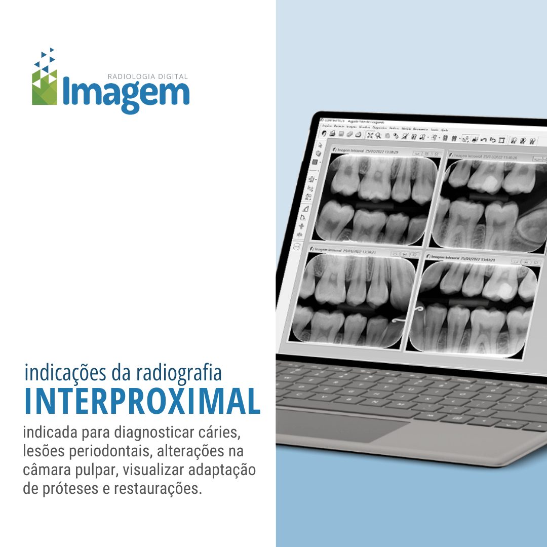 Indicações da radiografia interproximal – Imagem Radiologia