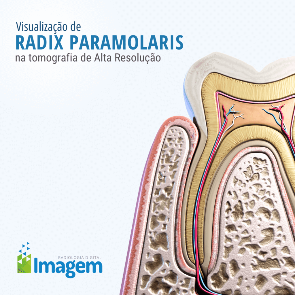 Visualização de Radix Paramolaris na Tomografia - Imagem Radiologia