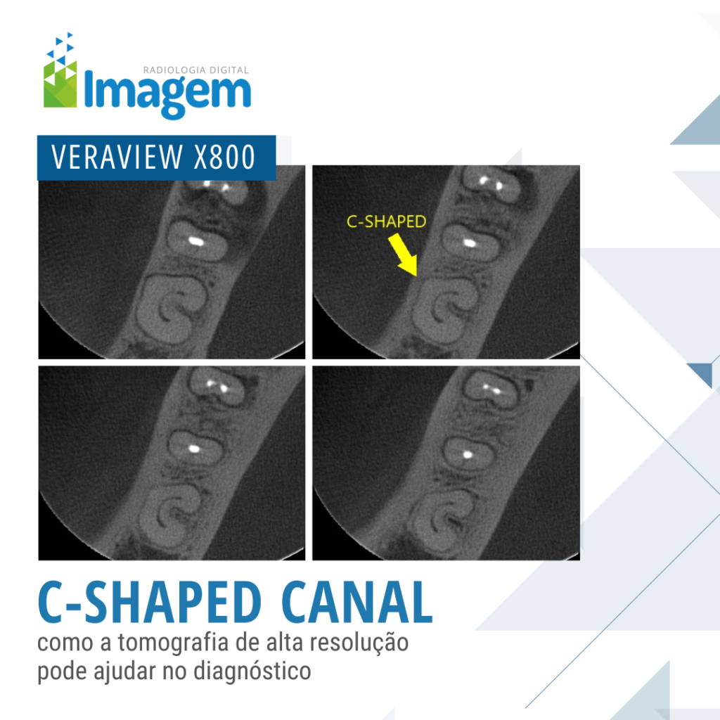 C-Shaped Canal na Tomografia de Alta Resolução - Imagem Radiologia